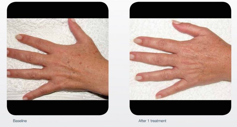 Cosmetic Lasers Long Beach | IPL Photorejuvenation | Heller Dermatology ...