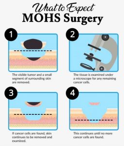 MOHS Micrographic Skin Cancer Surgery Long Beach | Heller Dermatology ...