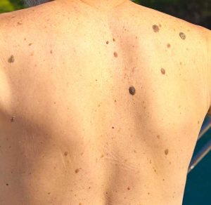 Seborrheic Keratoses Treatment Long Beach | Heller Dermatology and ...